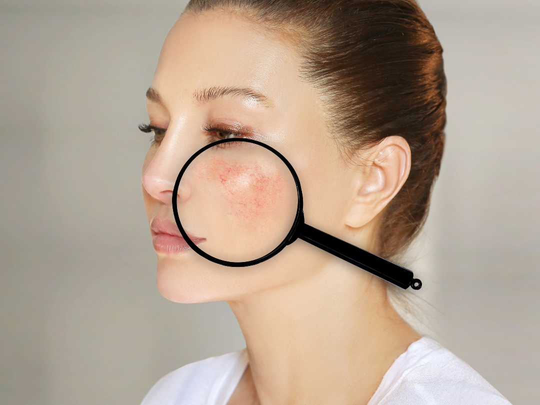 Understanding Lupus | Mommy Rheum