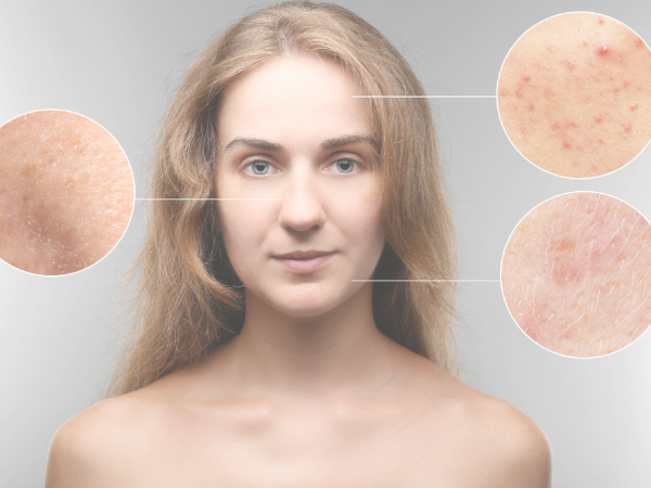 4 Things You Need to Know About Gut Health and Acne | Mommy Rheum